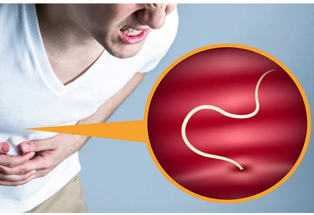 Penyakit Cacingan: Penyebab, Gejala, Pengobatan, dan Cara Pencegahan ...