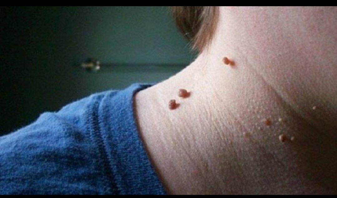 Penyebab Kutil dan Cara Mengatasinya: Kenali, Cegah, dan Obati Dengan ...